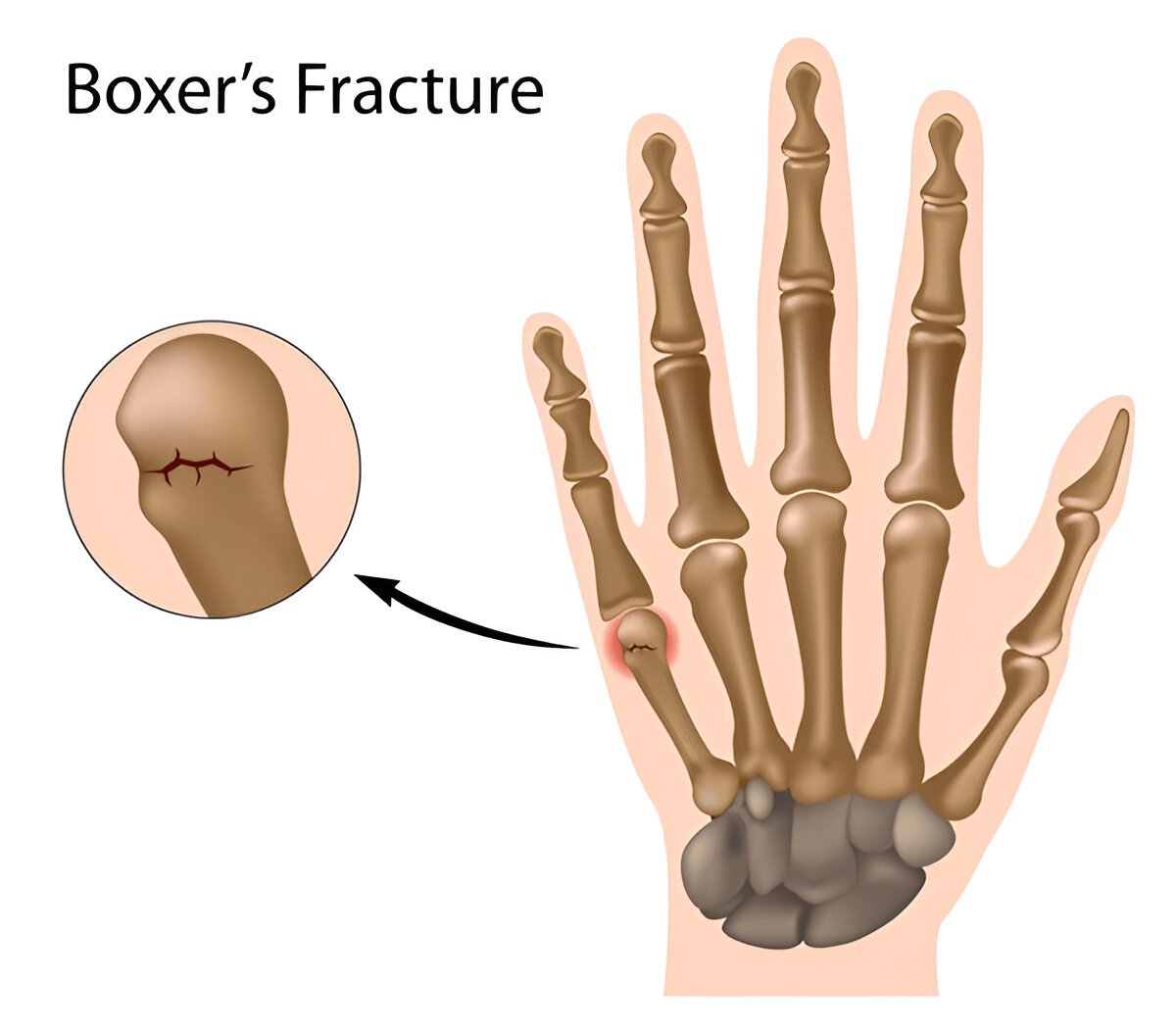 Understanding Hand Fractures: Types, Symptoms, and Treatment Options