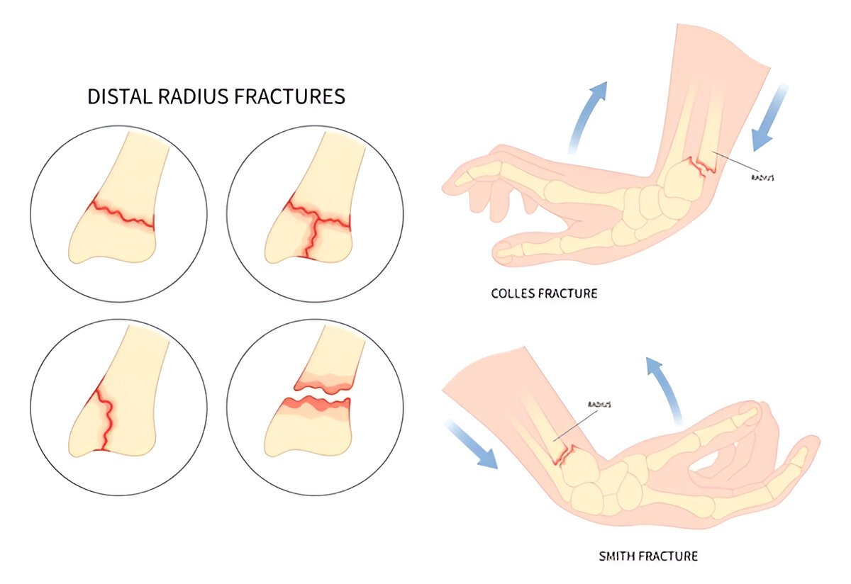 Understanding Hand Fractures: Types, Symptoms, and Treatment Options