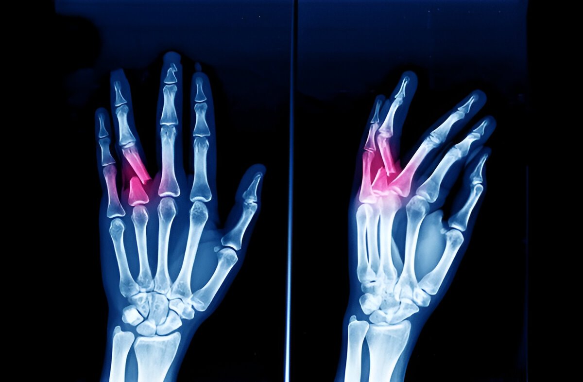 Understanding Hand Fractures: Types, Symptoms, and Treatment Options
