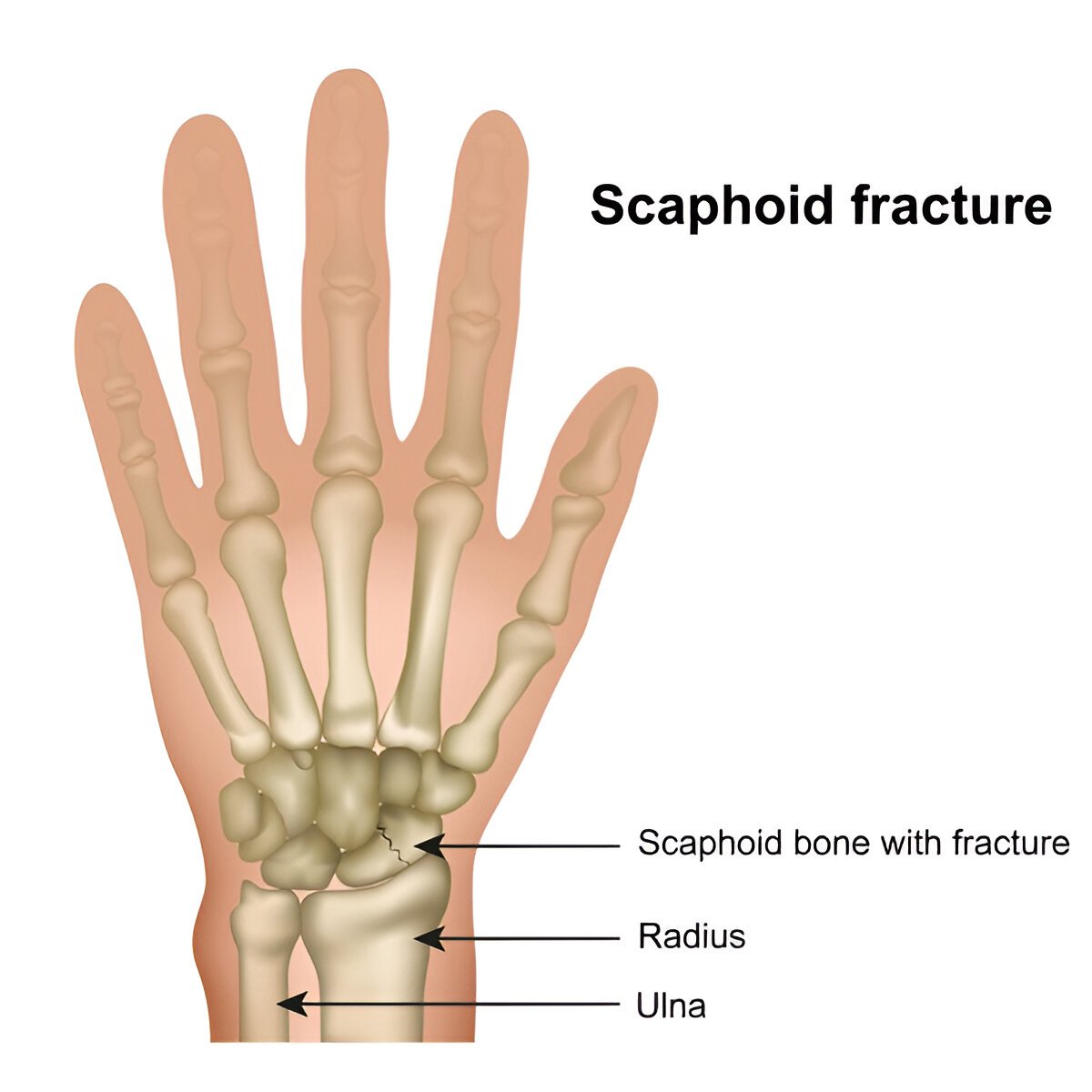 Understanding Hand Fractures: Types, Symptoms, and Treatment Options